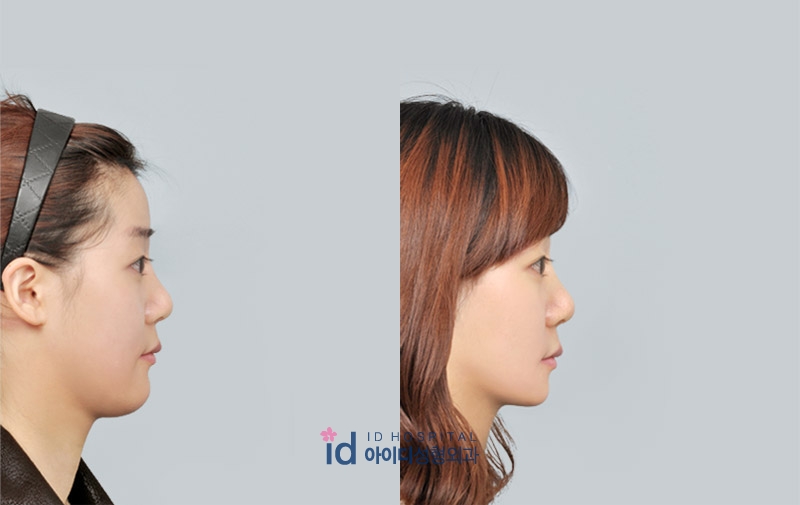 ID Hospital Korea: Quick and simple V-line creation, ‘Mini V-line surgery’