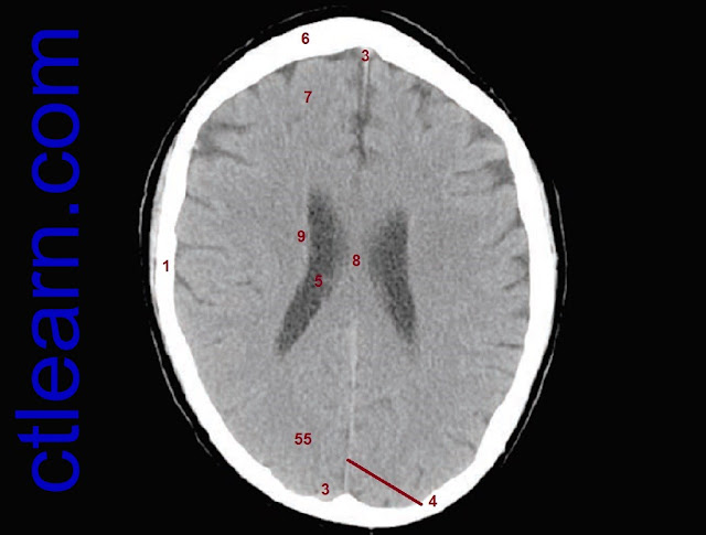 Anatomy CT Axial Brain
