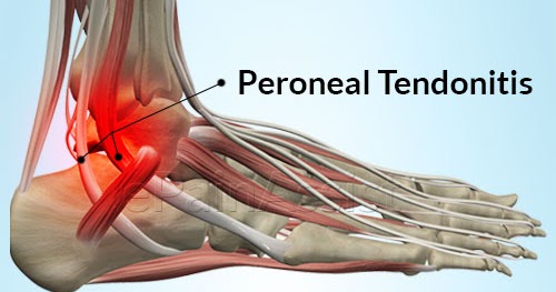 Tendinopatia dos Tendões Fibulares
