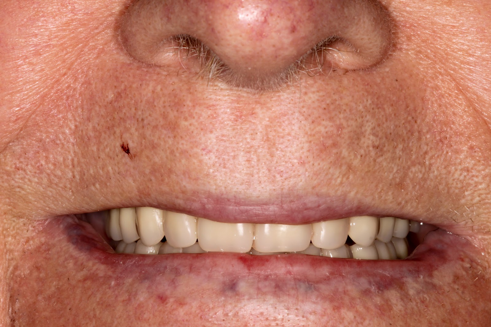 Boise Idaho Prosthodontics: Maxillary Complete Denture / Mandibular ...