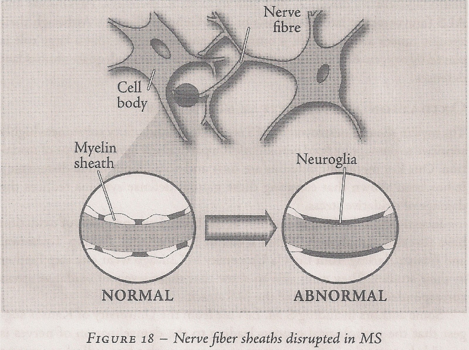 J-ROB-WELLNESS : MULTIPLE SCLEROSIS (MS) in Orlando
