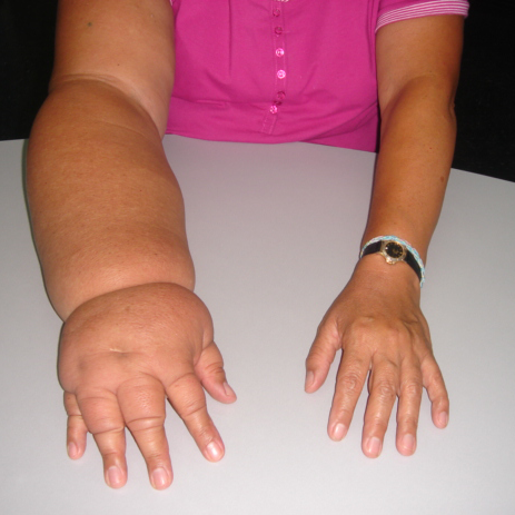EmYSa: Linfedema