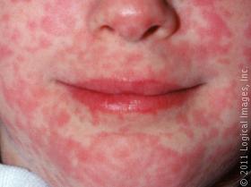 RUBEOLA ~ Programa Ampliado de Inmunización