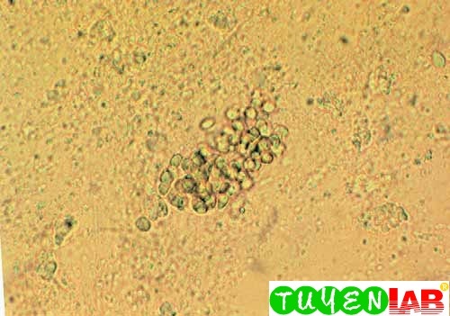 Atlas of Casts in urine | Free Medical Atlas