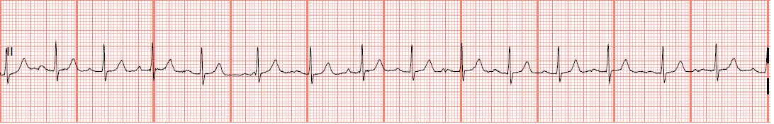 EKG Rhythm Strips 66