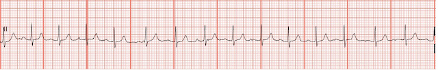 EKG Rhythm Strips 66
