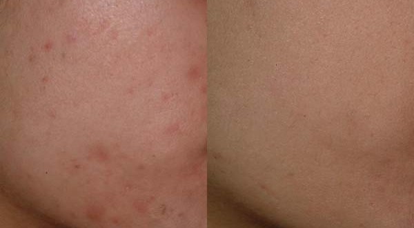 مجلتي: طرق سحرية لتتخلصي نهائيا من حب الشباب والرؤوس السوداء