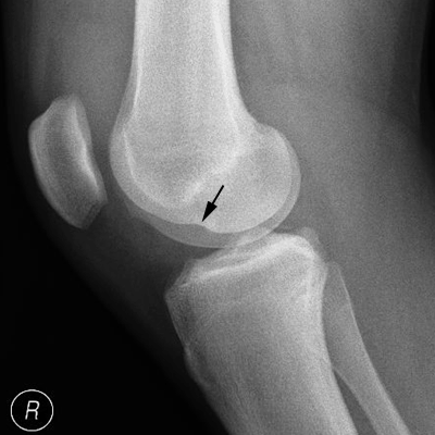Blog do Zorzi: LATERAL FEMORAL NOTCH SIGN