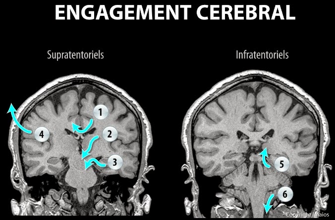 Ma bibliothèque en Imagerie Médicale: ENGAGEMENT CEREBRAL