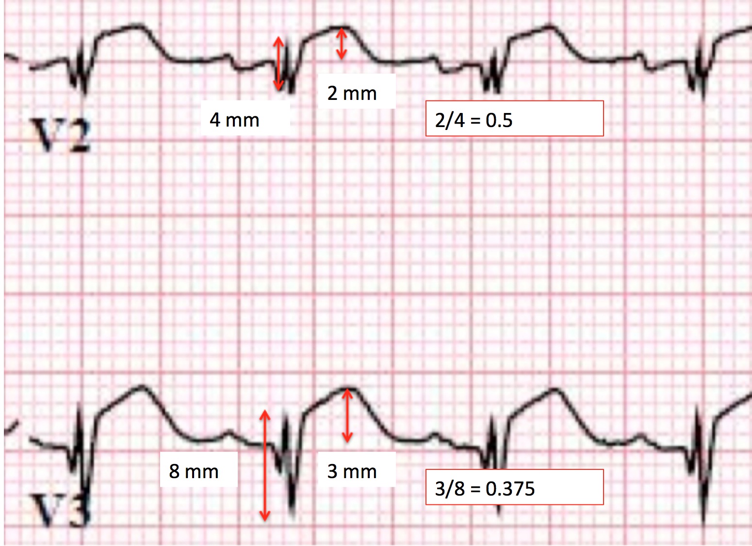 Dr. Smith's ECG Blog: Anterorlateral STEMI? Old Anterior MI? But cath ...