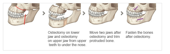 ID Hospital Korea: Curious about the difference between double jaw ...