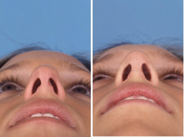 Dr. Dean Toriumi Reviews: Dean Toriumi: Secondary Rhinoplasty