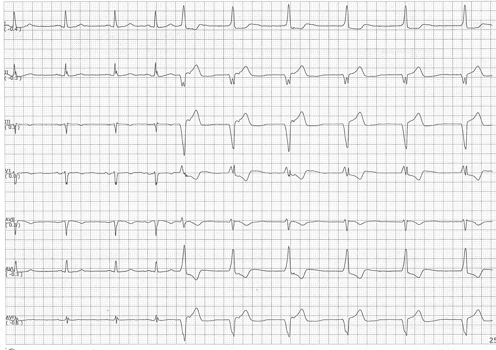Sinus Rhythm Changing to AIVR