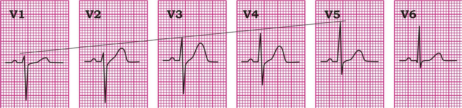 Yo Y Las Circunstancias: EKG NORMAL