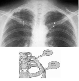 Medical Addicts: CERVICAL RIBS: X-ray