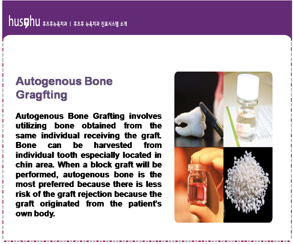 US Certified Dentist: Hus'hu NEWYORK Dental Clinic - Autogenous Bone ...