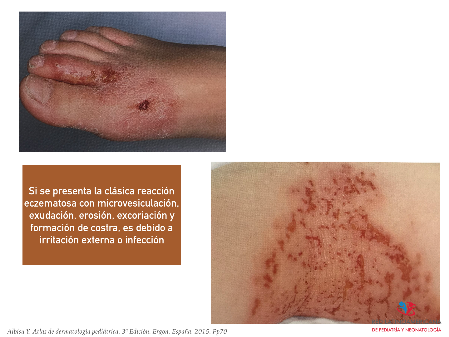 RED LATINOAMERICANA DE PEDIATRÍA Y NEONATOLOGÍA: [RESUMEN DE ...