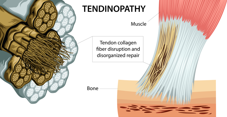 Como ocorre a tendinite, tendinose e tendinopatia?
