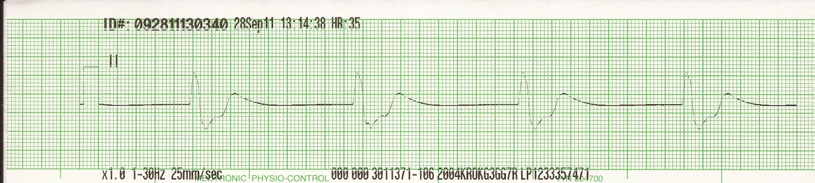 EKG Rhythm Strips 01