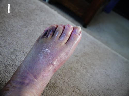 Une Québécoise en Californie: Pied cassé, 2ème partie / Broken Foot, Part 2