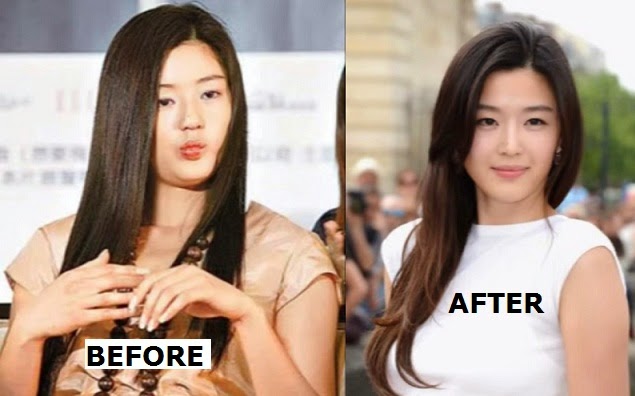 Jun Ji-hyun Surgery