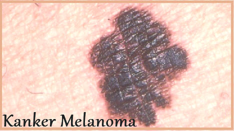 Jenis Dan Ciri Ciri Kanker Kulit | Cara Mengobati Kanker Kulit Secara Alami