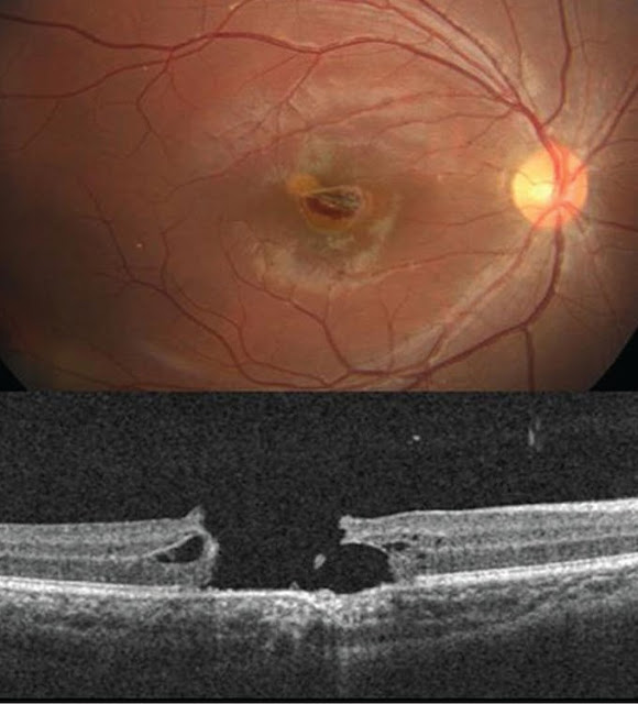 Innovations in Macular Hole Repair - Eyedolatry