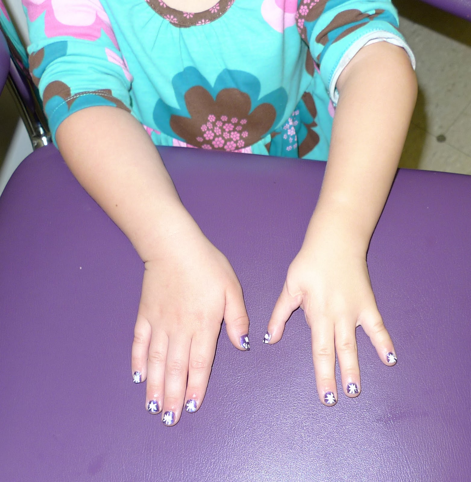 Pollicization- Creating a New Thumb | Congenital Hand and Arm ...