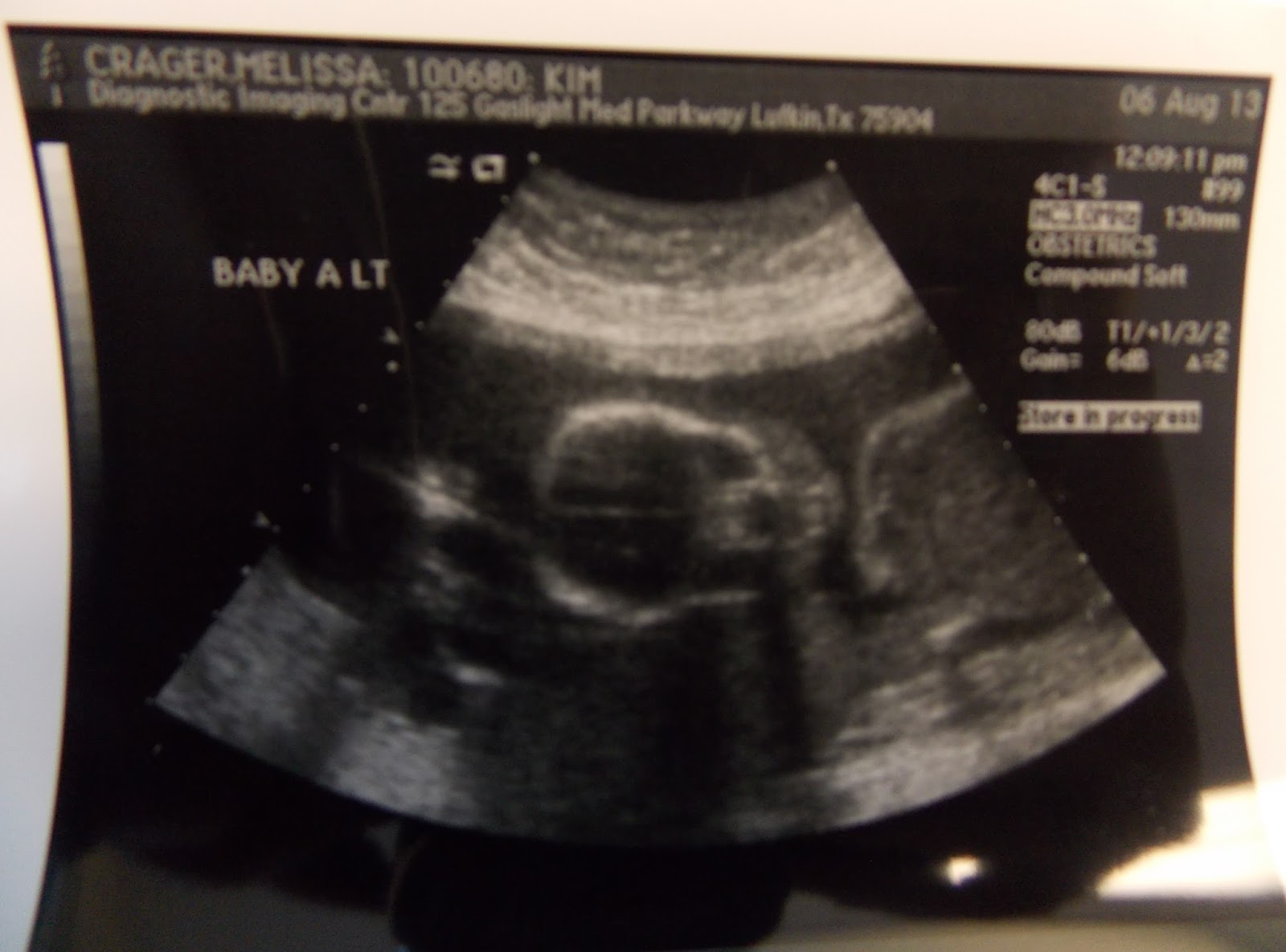 22 week ultrasound