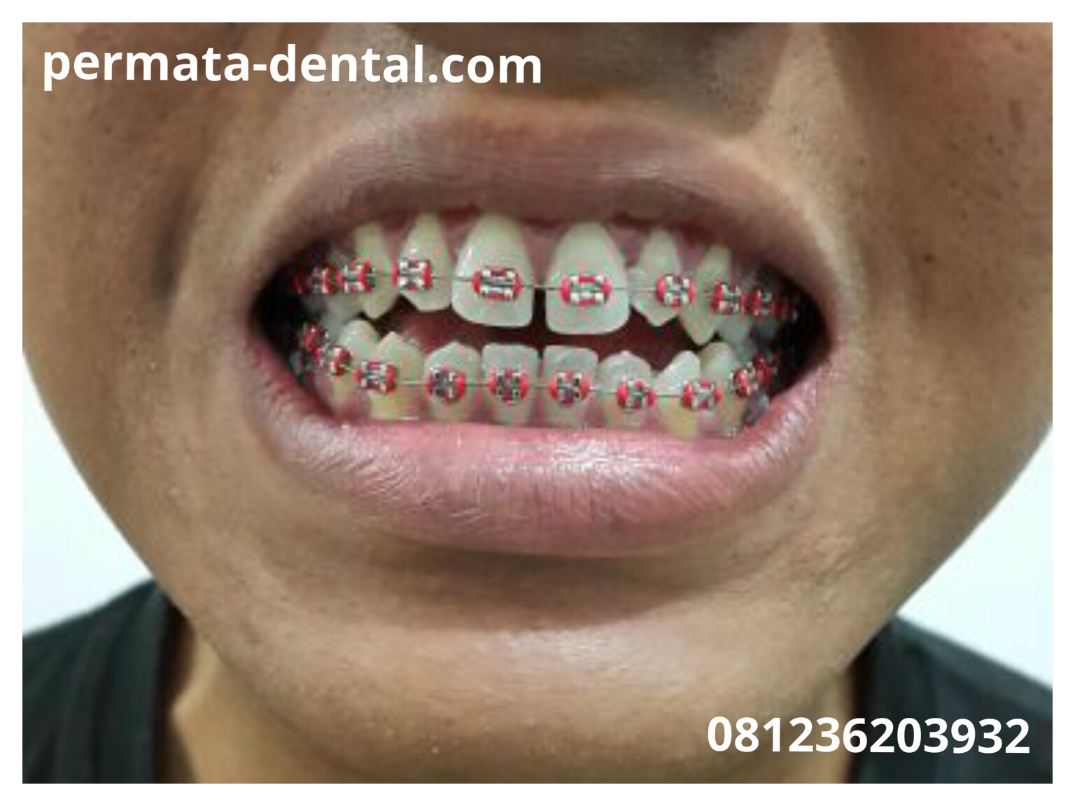 Klinik Gigi Jember Permata Dental : Pengen Punya Gigi Rapi Dan Terlihat ...