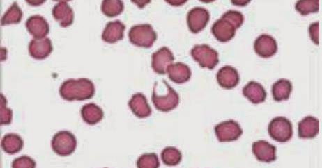 FICHERO DE HEMATOLOGIA: QUERATOCITOS