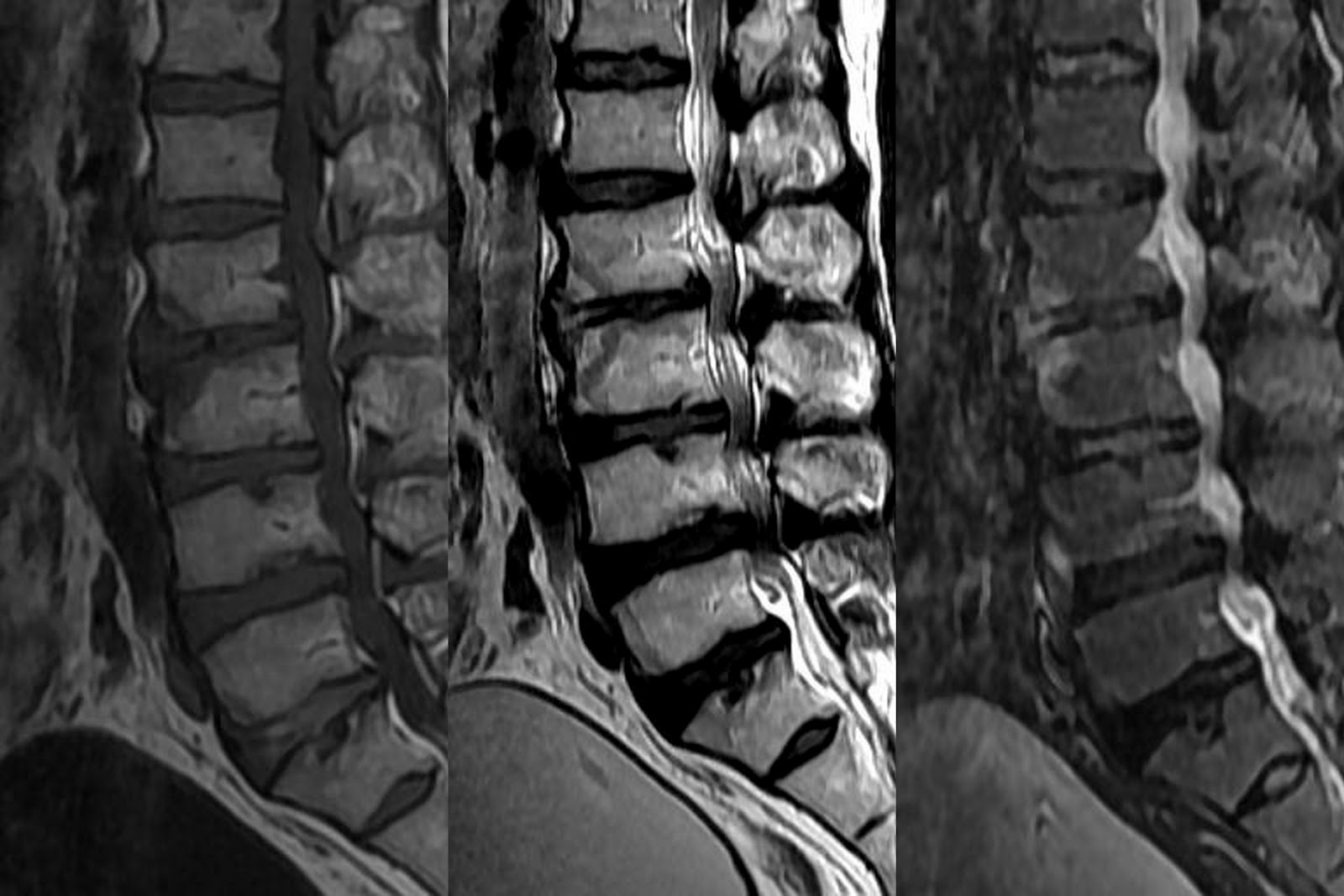 Dr Balaji Anvekar FRCR: Spondylodiscitis