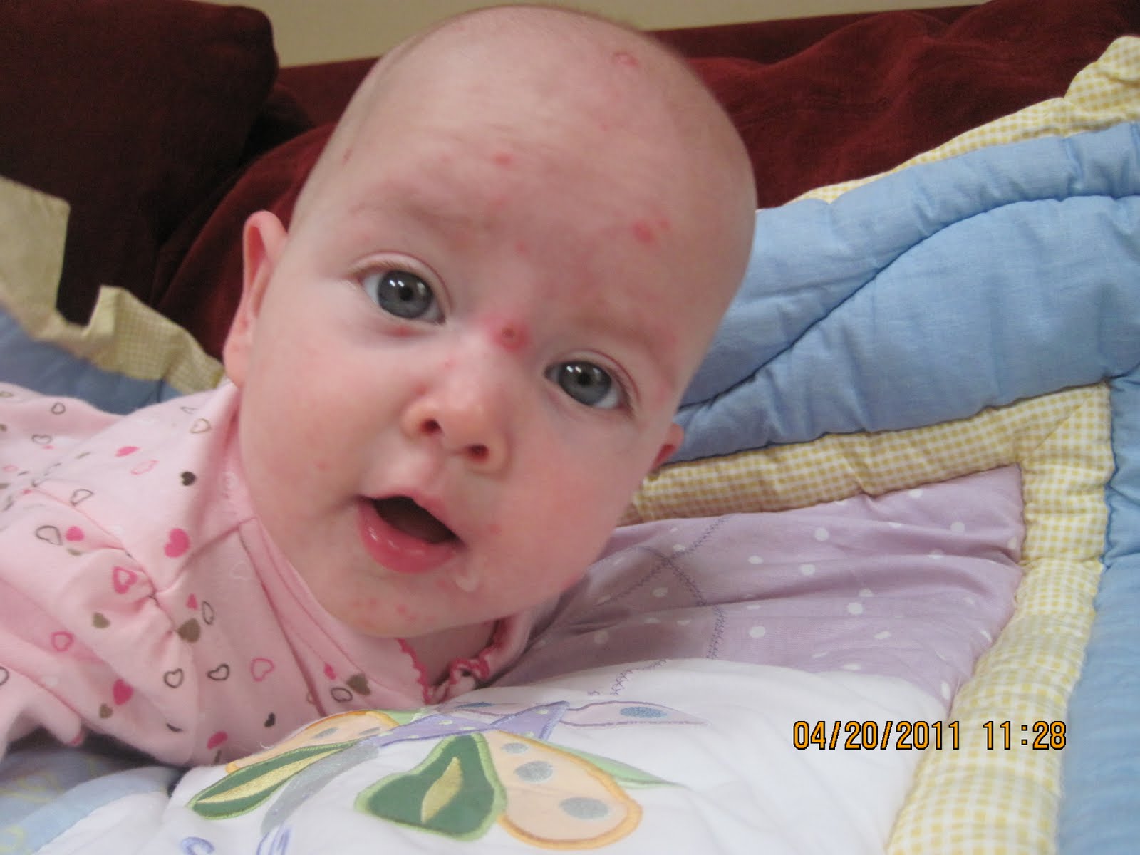 Busy Little Green Family: Ella has the Chicken Pox!
