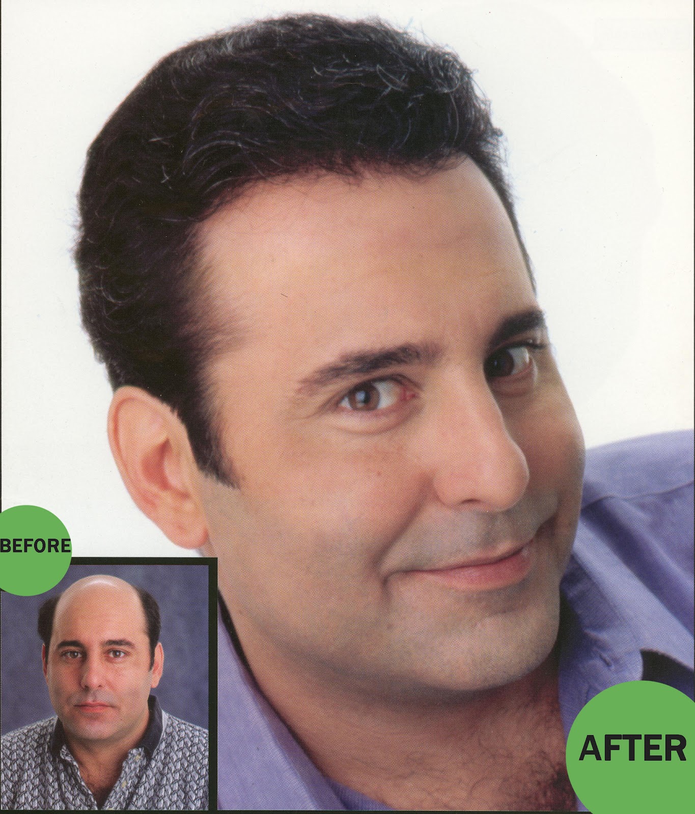 Hair Replacement For Men Preparing For Hereditary Balding