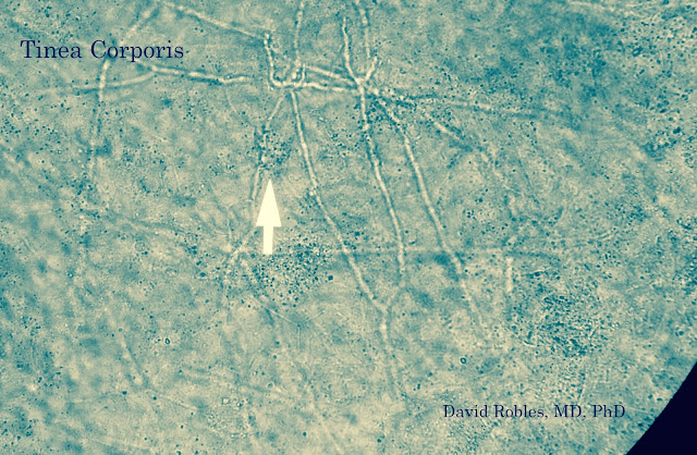 Tinea corporis ("Ringworm")