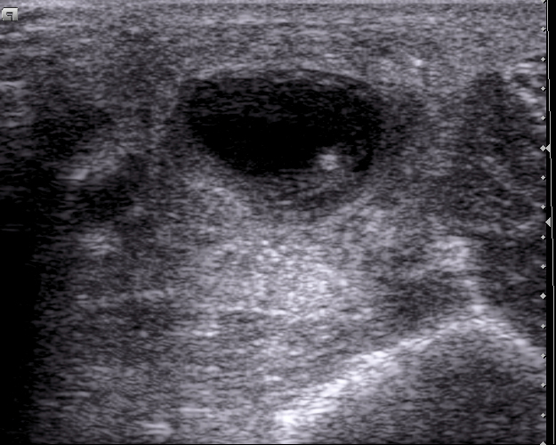 Radiodiagnosis - Imaging is Amazing-Interesting cases: Cysticercosis ...