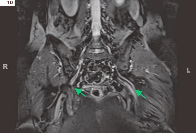 ESPE 203-2013: Plexo Sacro y patologías asociadas