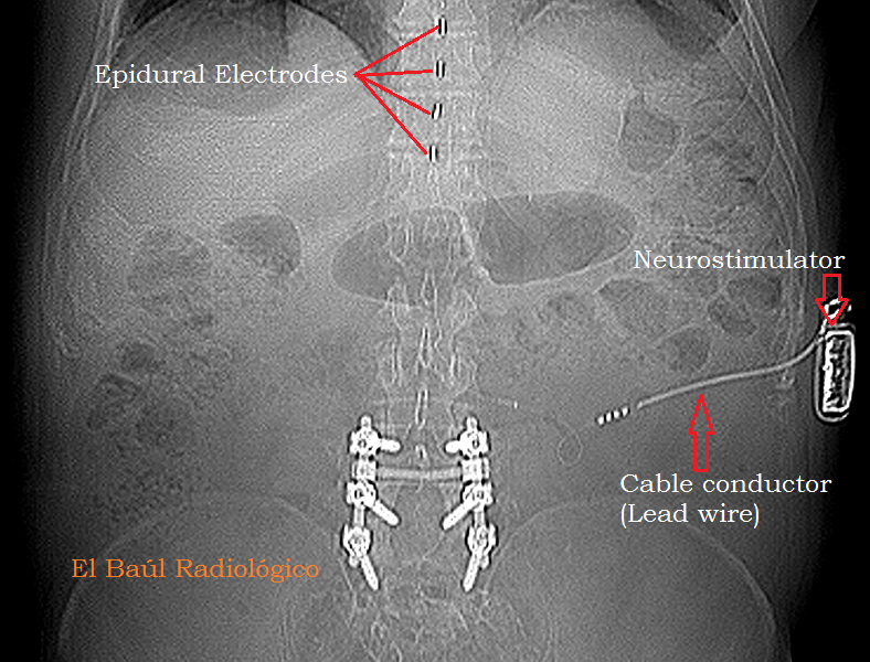 El Baúl Radiológico: NEUROESTIMULADOR EPIDURAL ESPINAL: PRECAUCIÓN EN ...
