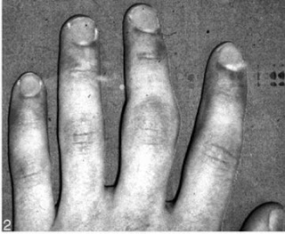 Tom's Physiotherapy Blog: Youngsters: Epiphyseal Plate Injuries