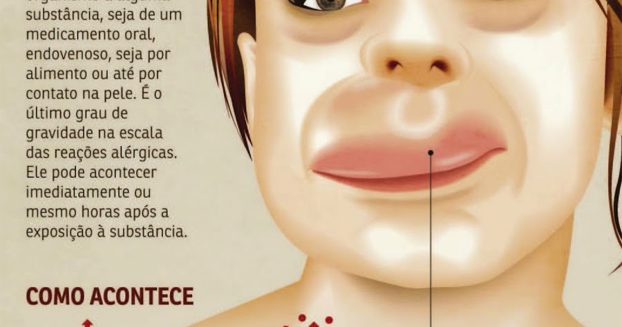 Blog Dr. Carlos: Anafilaxia - Reação anafilática