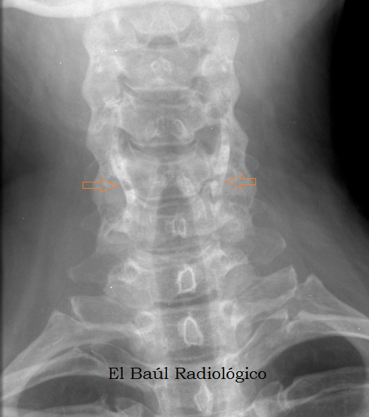 El Baúl Radiológico: CALCIFICACIONES SEUDOTUBULARES DEL CARTÍLAGO ...