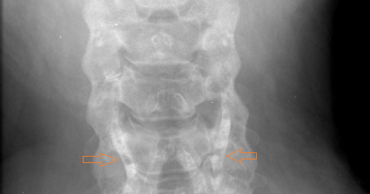 El Baúl Radiológico: CALCIFICACIONES SEUDOTUBULARES DEL CARTÍLAGO ...