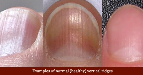 What vitamin deficiency causes ridges in fingernails - Awesome Nail