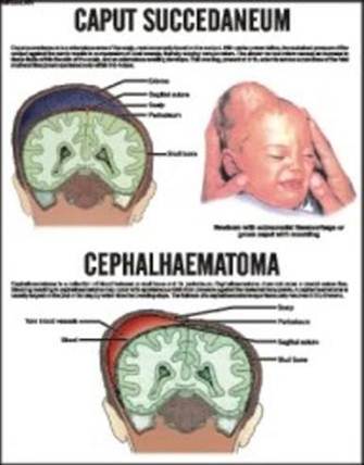 sri raningsih: Caput succedaneum dan Cephalhematoma