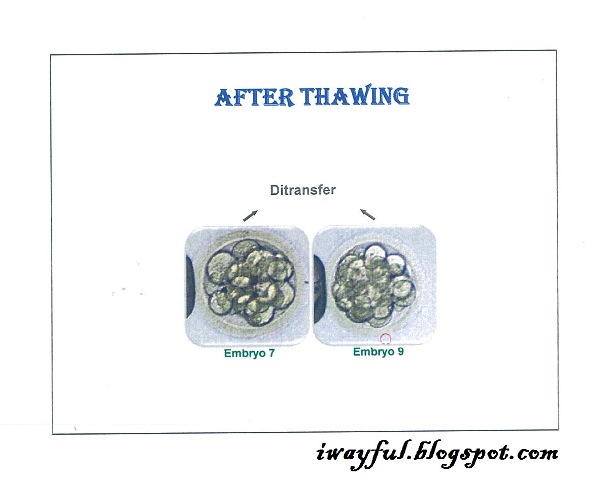 Welcome to Iwayful Blog: IVF (FET): Frozen Embryo Transfer (h+15)