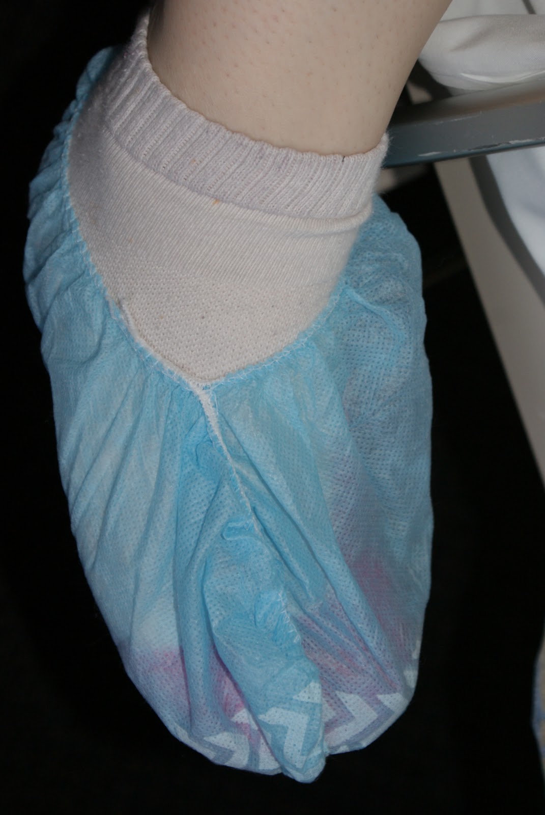 Braces + SARPE/SARME Surgery