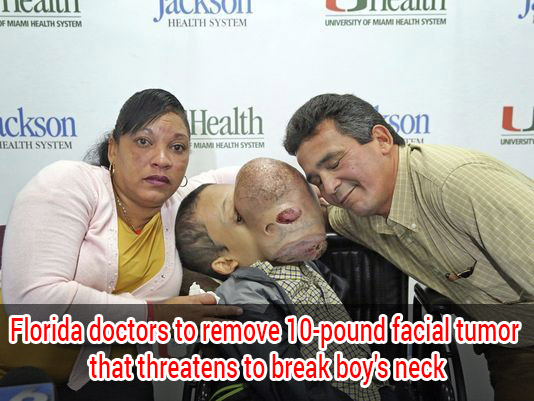 Florida doctors to remove 10-pound facial tumor that threatens to break ...