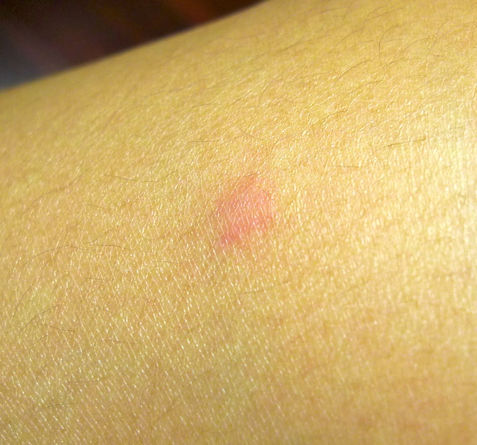 Bite MD Review: An effective way to get rid of those pesky insect bites