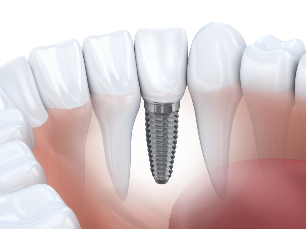 Abutment Implant Là Gì? - Hút Mỡ Toàn Thân