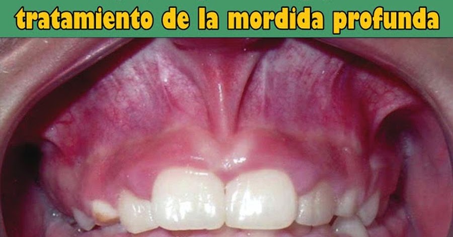 ORTODONCIA: Etiología, diagnóstico y plan de tratamiento de la mordida ...